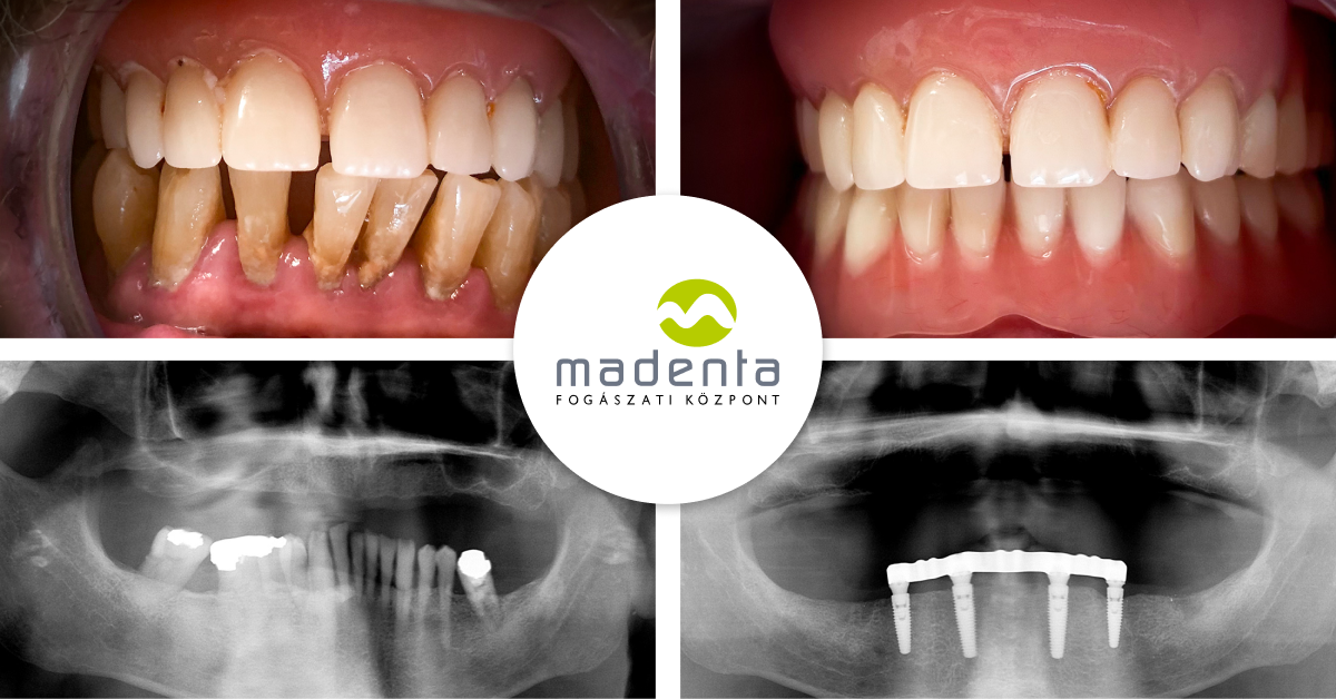 Stéges fogsor: a teherbíró, stabil, anyagilag kedvező megoldás ...