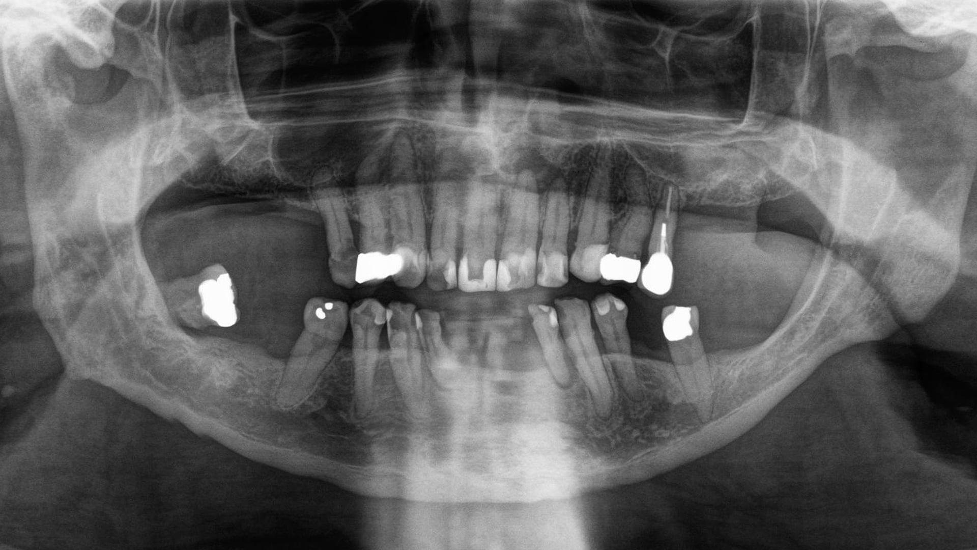 All-on-4® – fix, nem kivehető teljes fogsor akár 48 óra alatt - Madenta ...